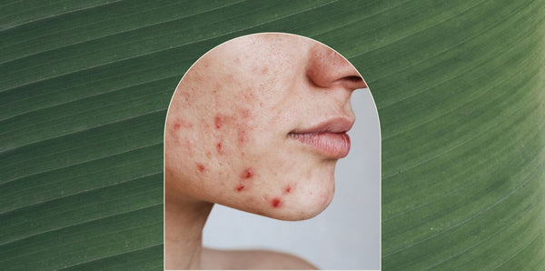 Comment contrôler l’acné hormonale avec des soins adaptés - Innovaderm ...