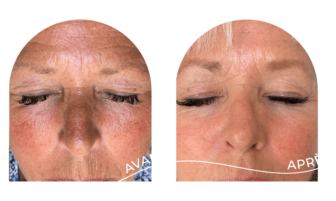 Rajeunissement de la peau | Innovaderm - Innovaderm esthetique