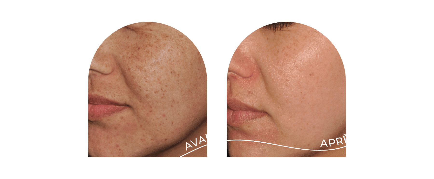 Élimination des taches pigmentaires | Innovaderm - Innovaderm esthetique