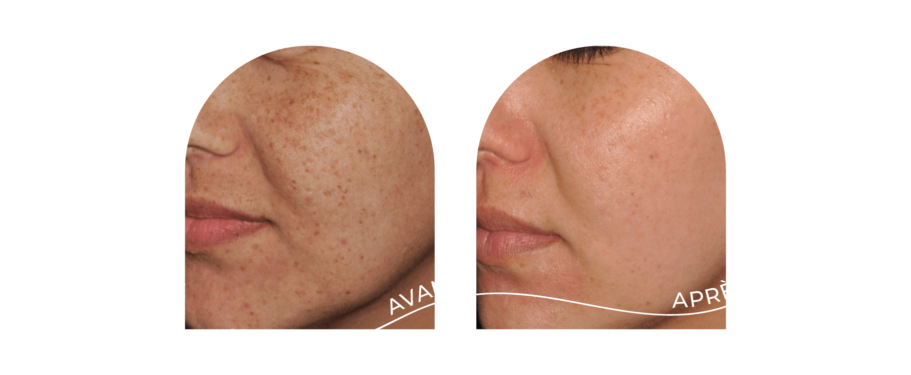 Élimination des taches pigmentaires | Innovaderm - Innovaderm esthetique